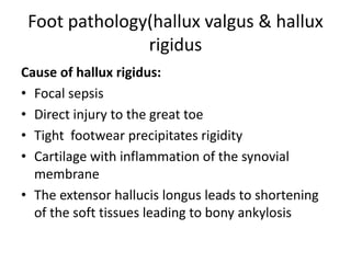 Hallux valgus | PPTX