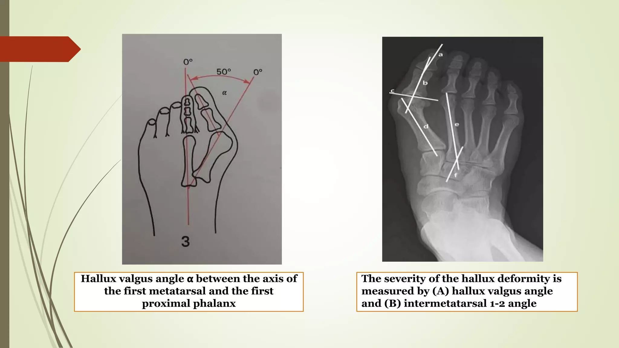 Hallux valgus Deformity | PPTX