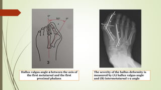 Hallux valgus Deformity | PPTX