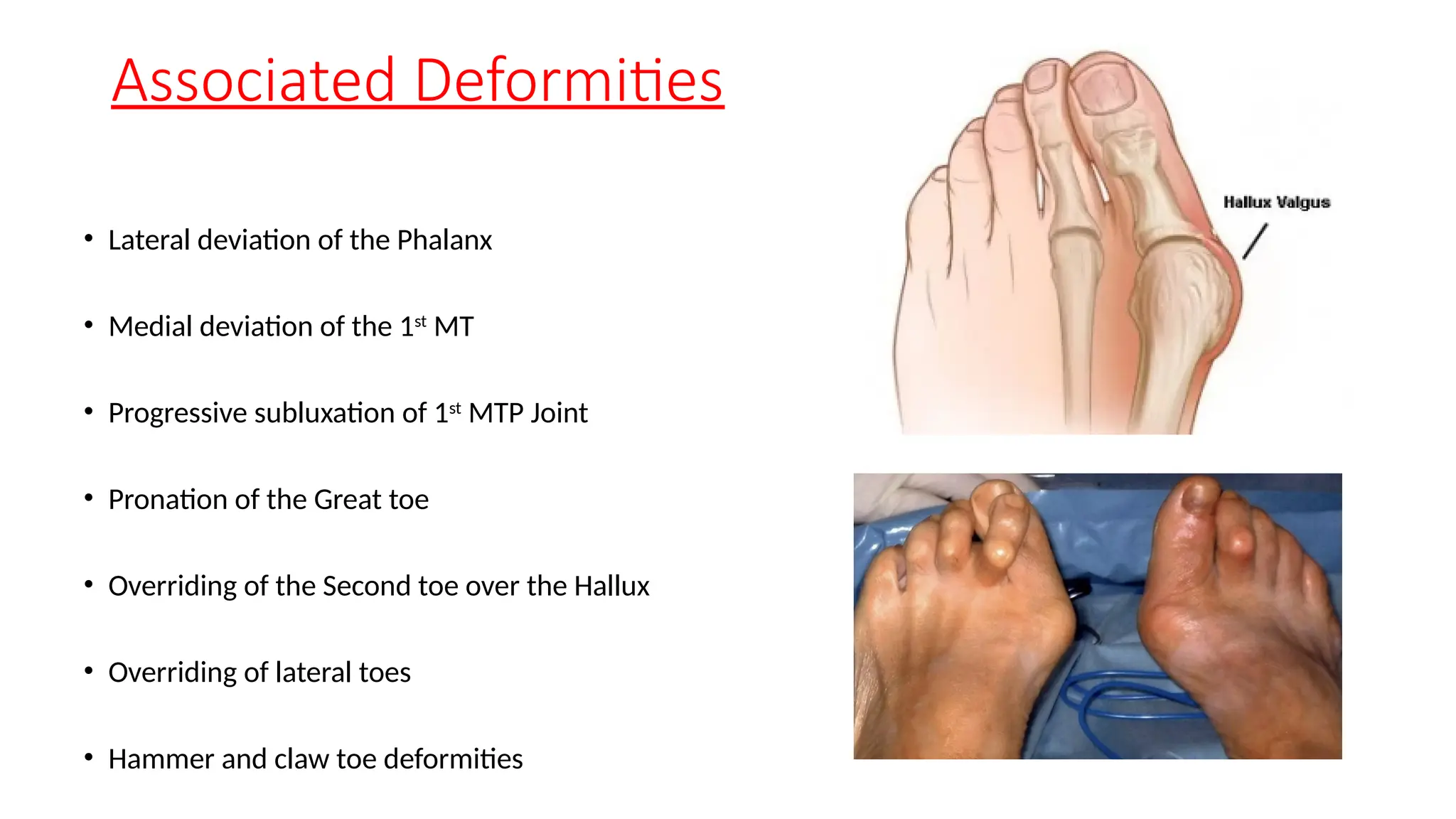 Hallux Valgus Principles and Management | PPTX