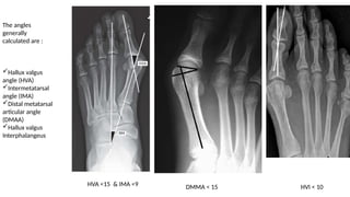 Hallux Valgus Principles and Management | PPTX