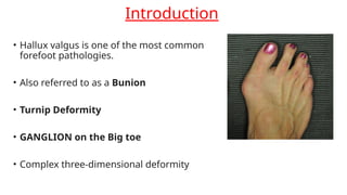 Hallux Valgus Principles and Management | PPTX