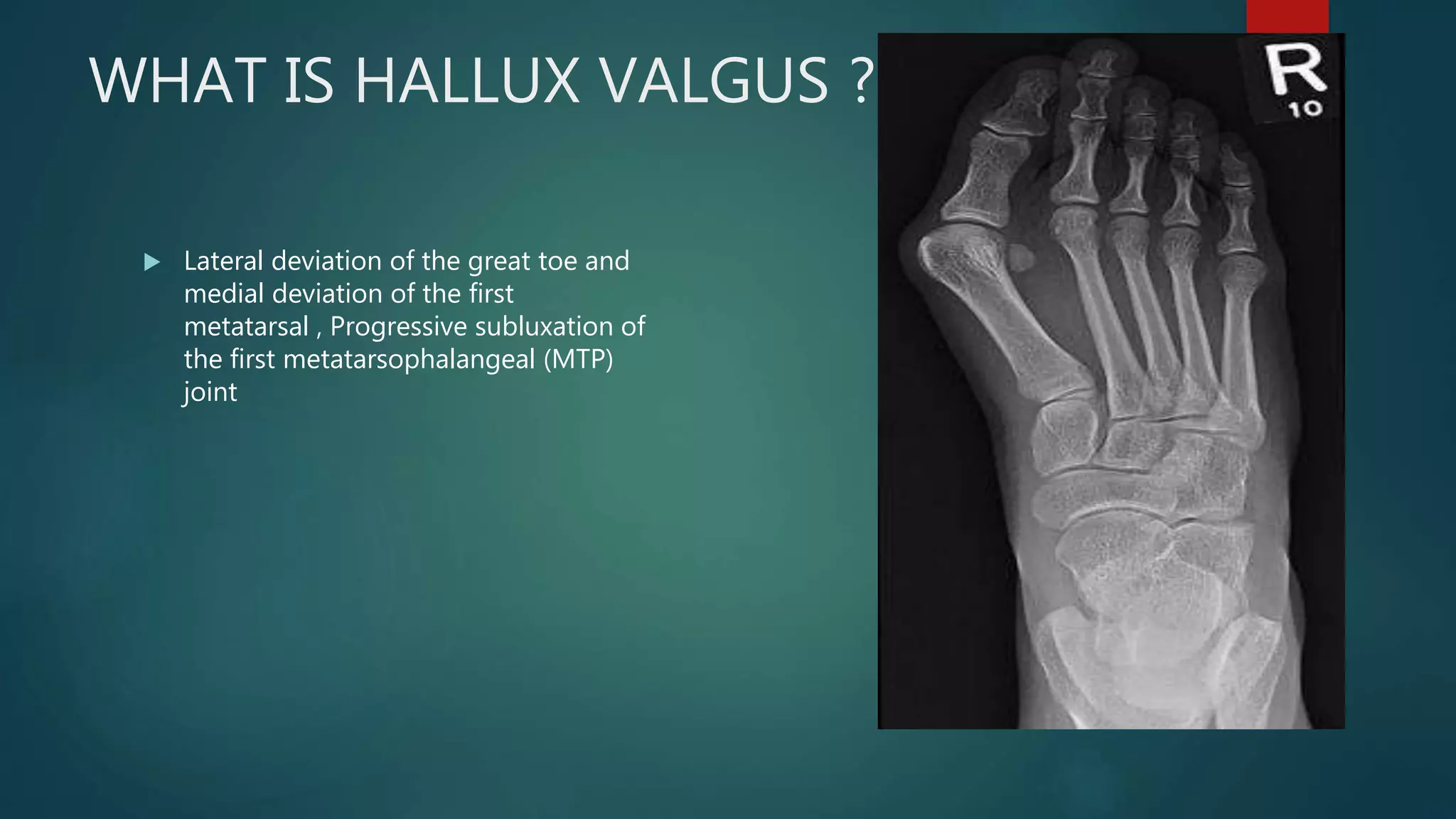 Hallux valgus - Practical approach and recent advances | PPTX
