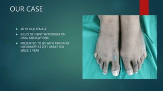 Hallux valgus - Practical approach and recent advances | PPTX