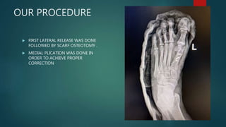 Hallux valgus - Practical approach and recent advances | PPTX