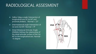 Hallux valgus - Practical approach and recent advances | PPTX
