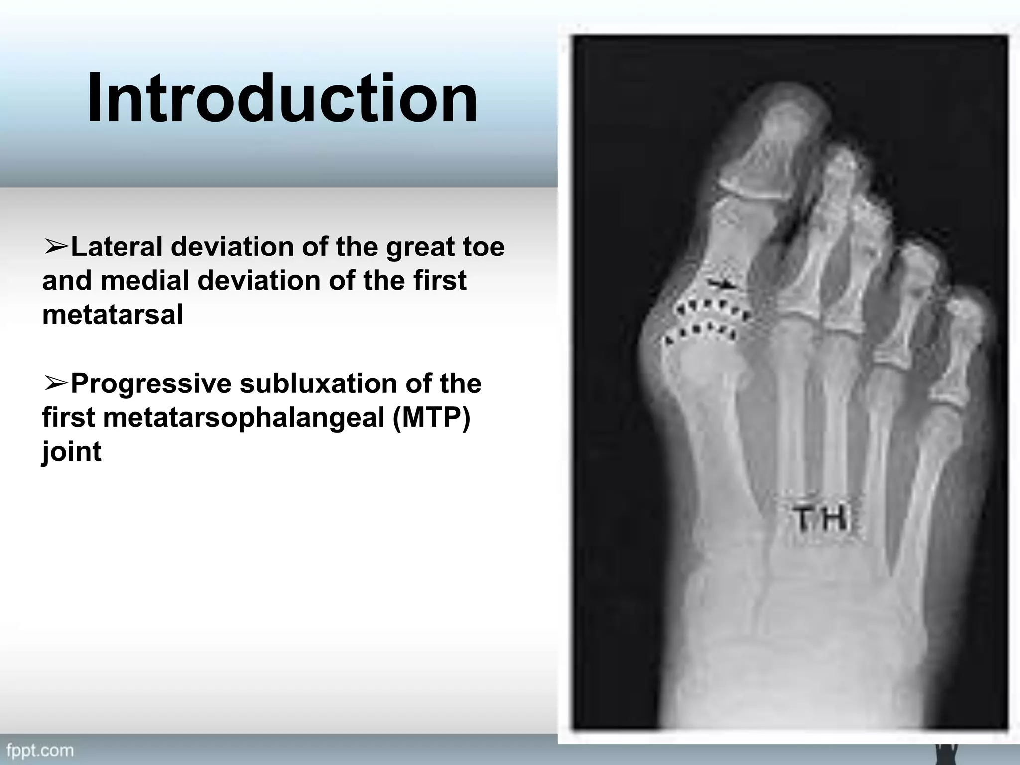 hallux valgus.pptx