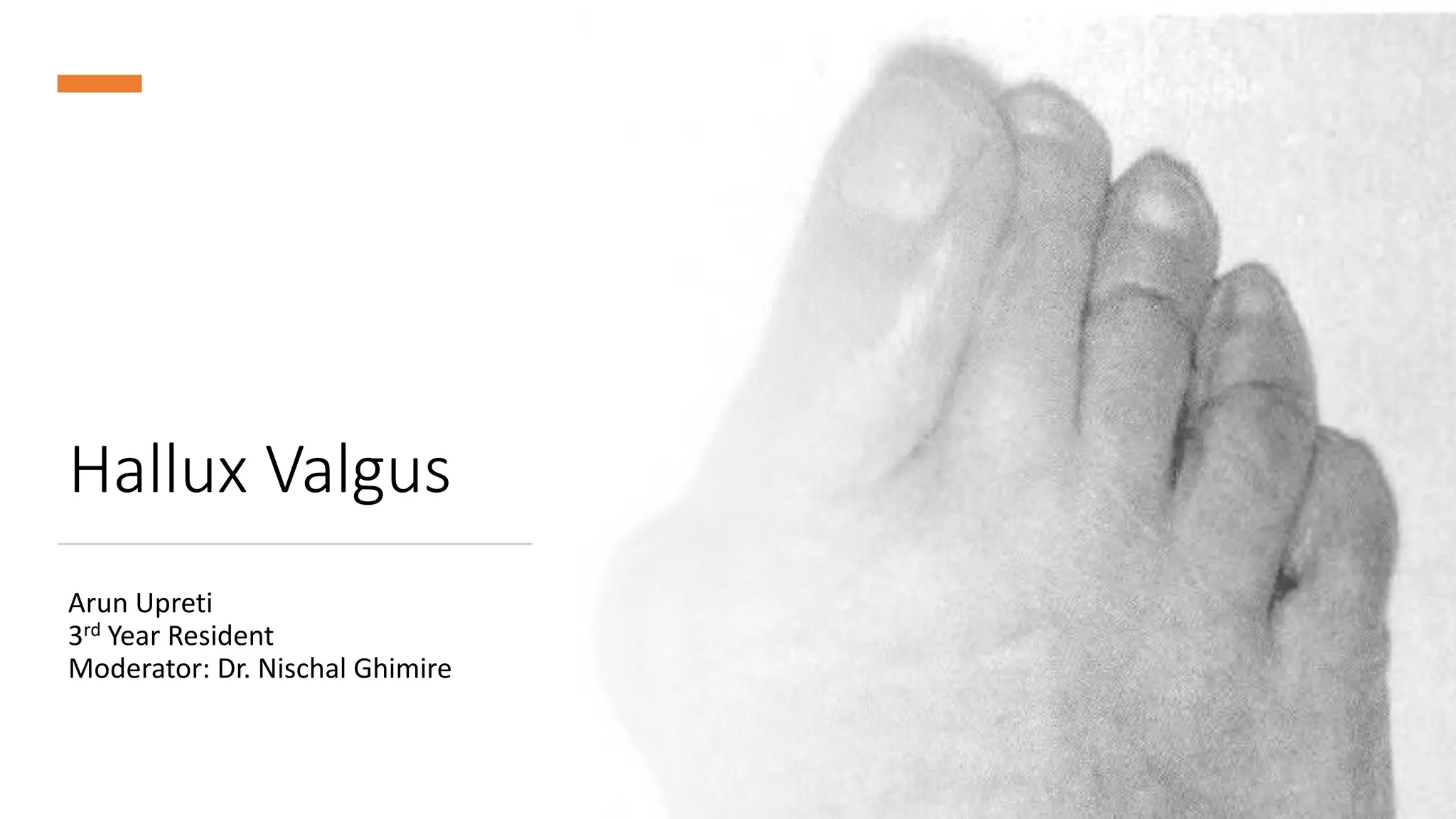 Principles of Management of Hallux Valgus | PPT