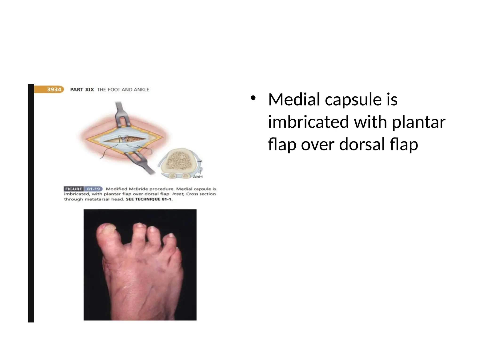 hallux valgus orthopaedic practices.pptx