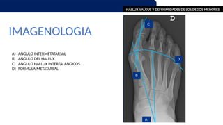 hallux valgus del pie. importante para saber la anatomia y tratamiento ...