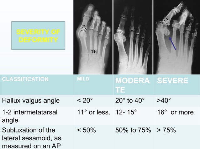 hallux valgus2.ppt.As its important topic for exams. | PPT