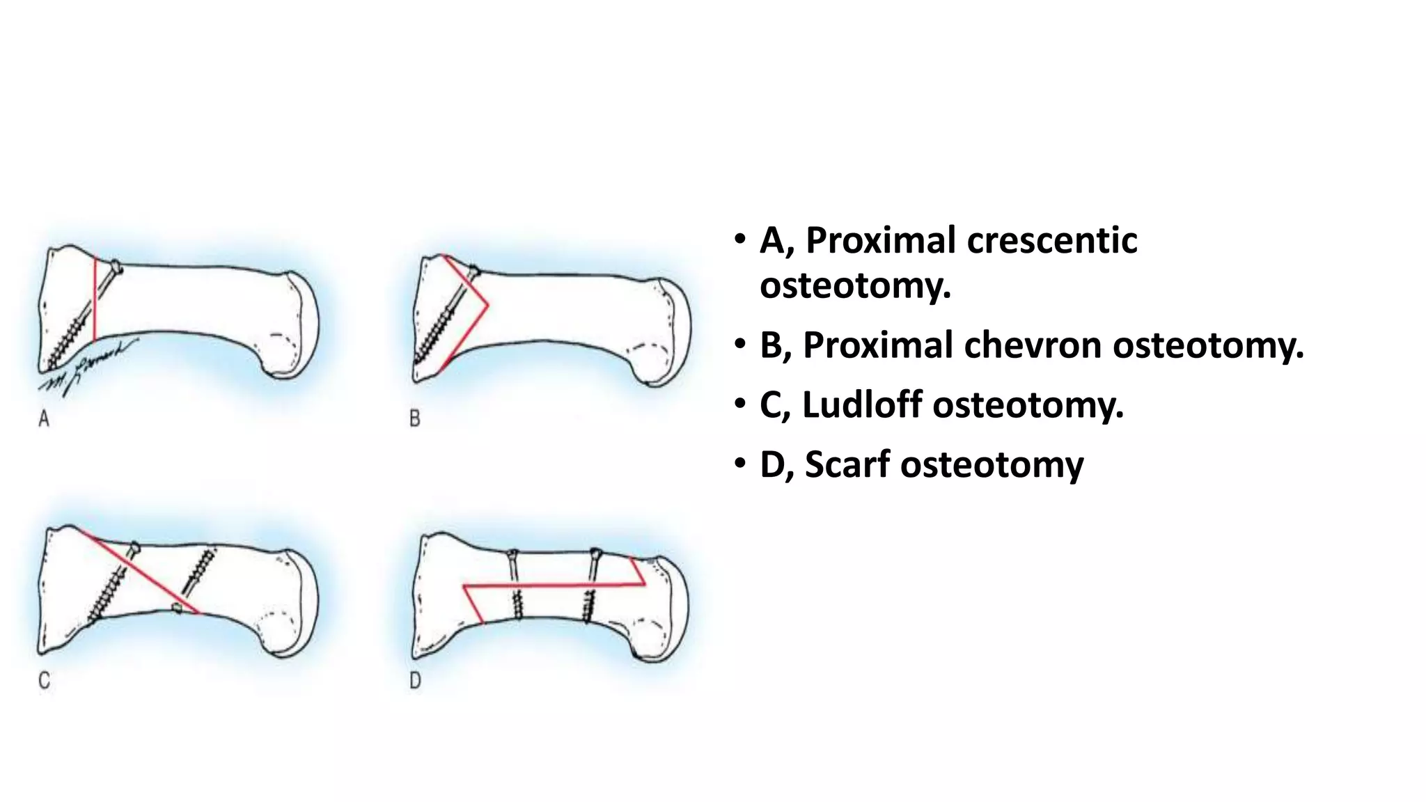 Hallux valgus (bunion) | PPTX