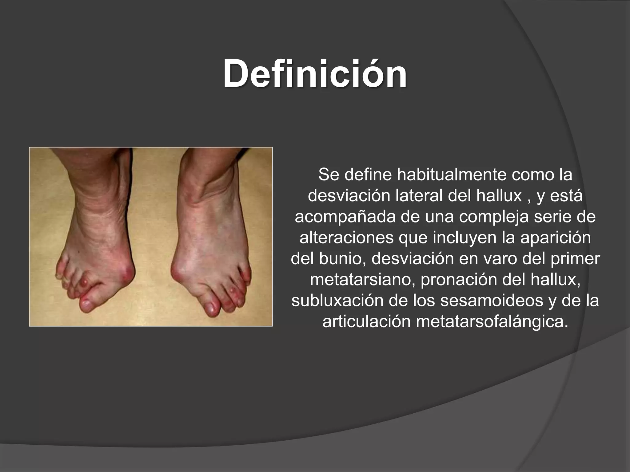 Hallux valgus | PPT