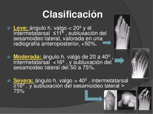 Hallux valgus