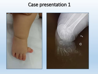 Congenital Hallux varus: How to deal with it? | PPTX