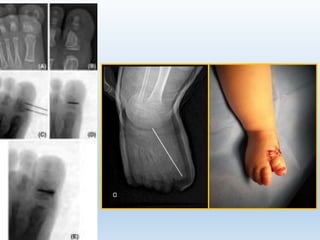 Congenital Hallux varus: How to deal with it? | PPTX