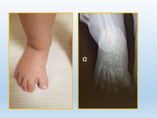 Congenital Hallux varus: How to deal with it? | PPTX