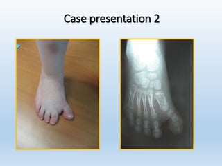 Congenital Hallux varus: How to deal with it? | PPTX