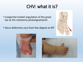 Congenital Hallux varus: How to deal with it? | PPT
