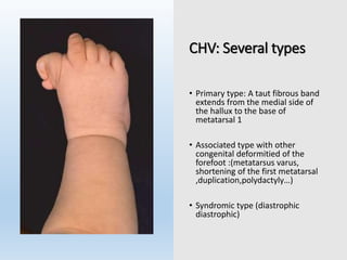 Congenital Hallux varus: How to deal with it? | PPTX