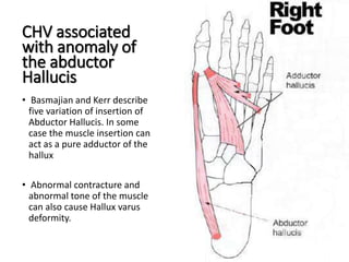 Congenital Hallux varus: How to deal with it? | PPTX