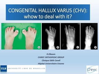 Hallux Varus
