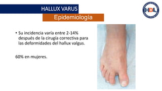 HALLUX VARUS.pptx
