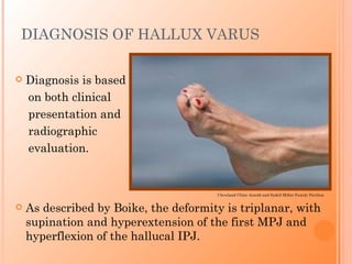 Hallux Varus | PPT