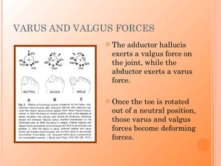 Hallux Varus | PPT