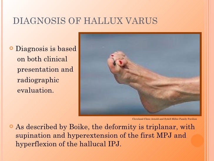 Hallux Varus