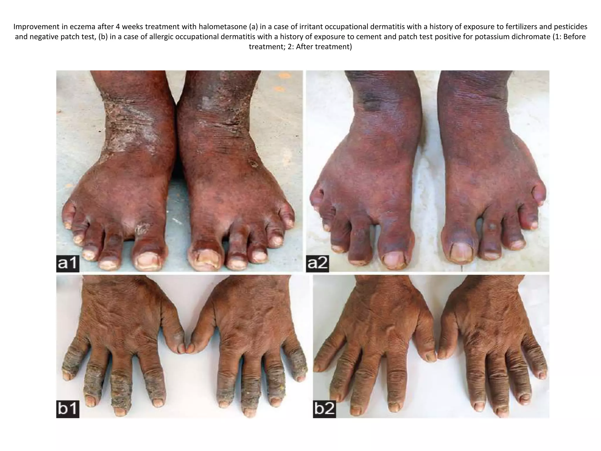 Halometasone monohydrate (0 | PPTX