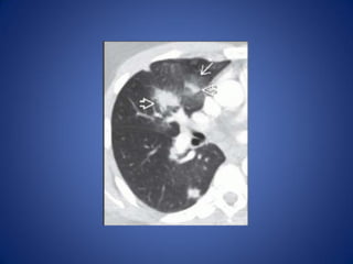 Halo sign | PDF