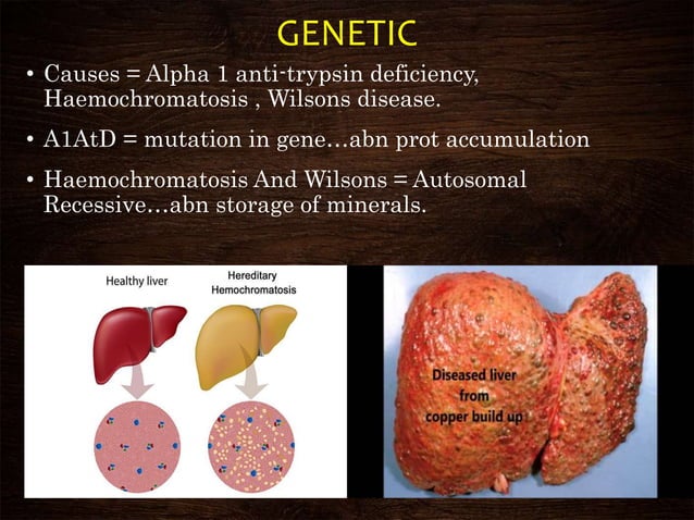 Halothane induced hepatitis | PPTX