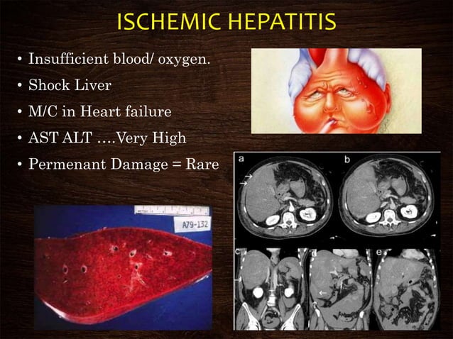 Halothane induced hepatitis | PPTX