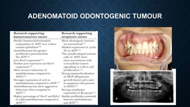Hamartoma.pptx | Dental Health | Diseases and Conditions