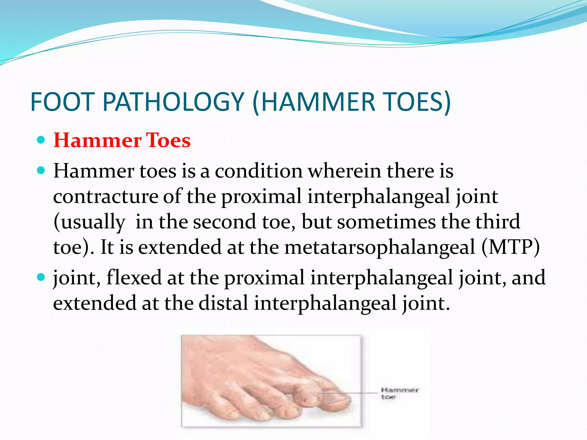 Hammer toes | PPTX