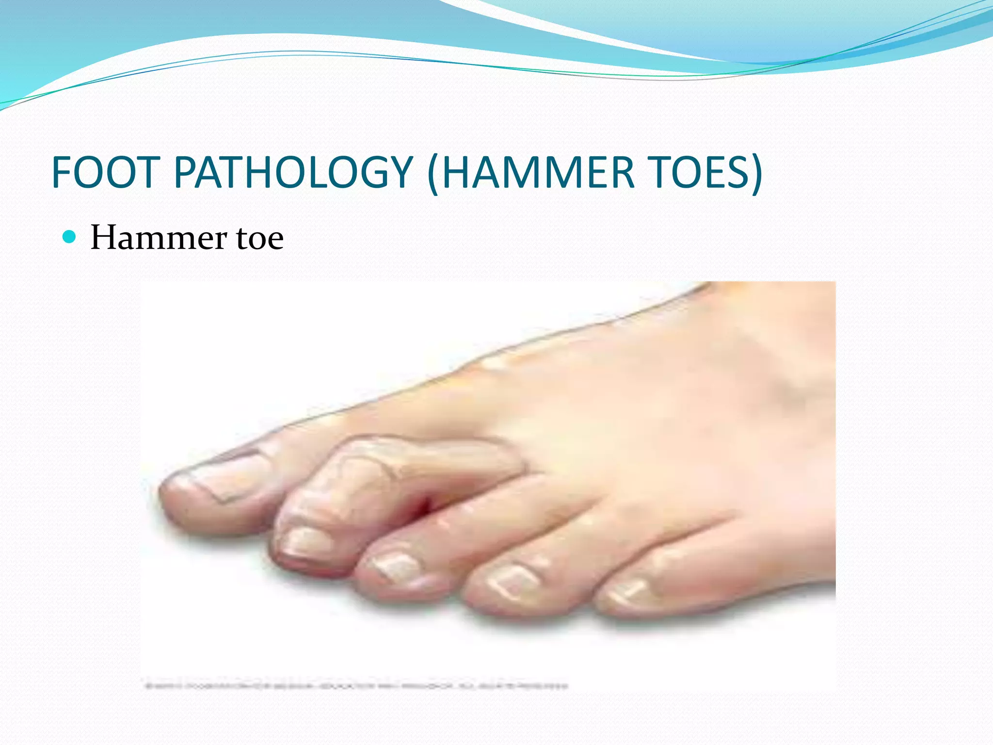 Hammer toes | PPTX