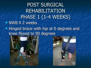Hamstring Avulsion Repair Rehabilitation | PPT