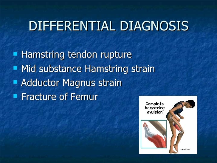 Hamstring Avulsion Repair Rehabilitation