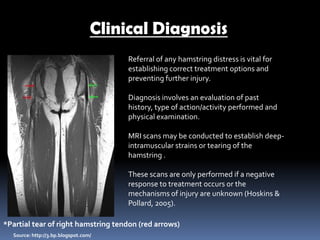 Hamstring strain pp | PPTX