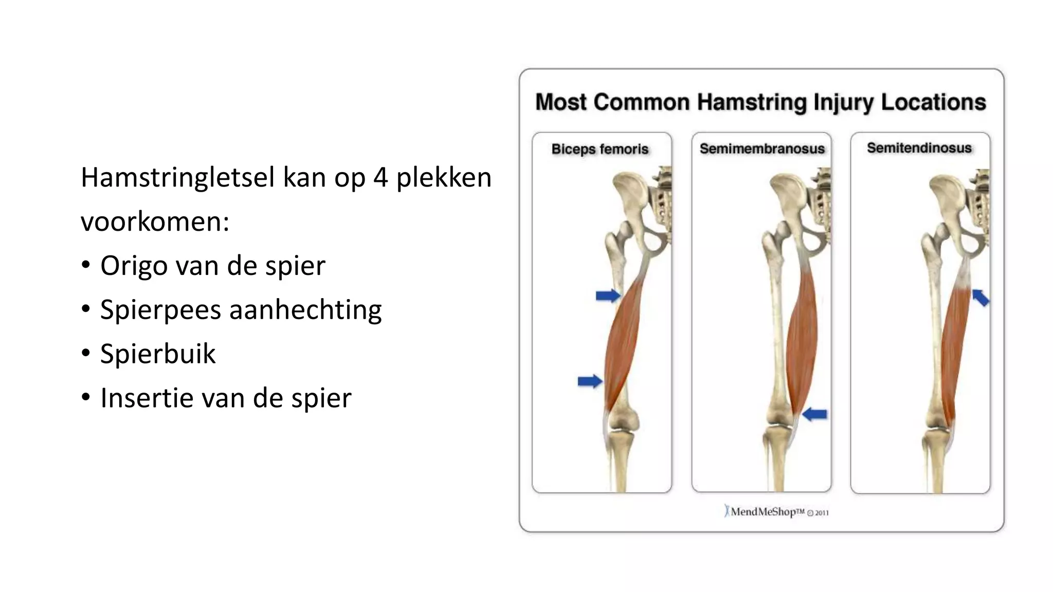 Hamstring tendinopathy | PPTX