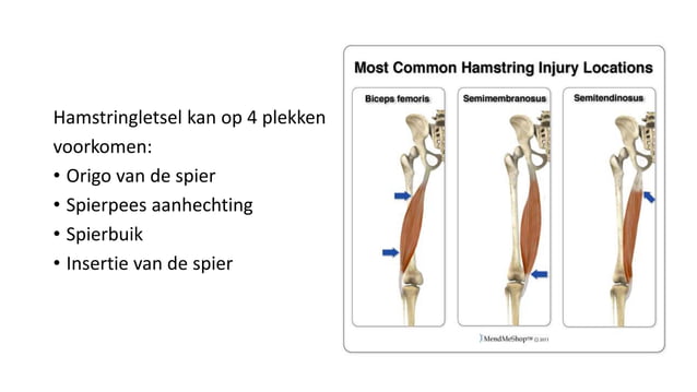 Hamstring tendinopathy | PPTX