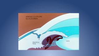 Acute closure angle glaucoma opthalmology.pptx