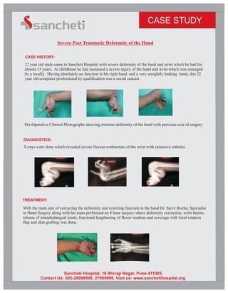Severe Post Traumatic Deformity of the Hand | PDF