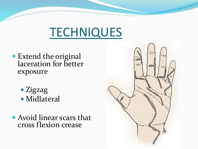 Tendon injuries of hand