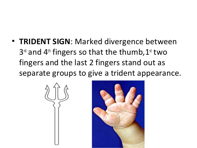 Hand a clue to pediatric diagnosis