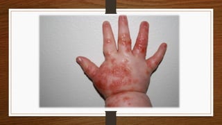 Hand-Foot-and-Mouth-Disease lesson yes thank you | PDF