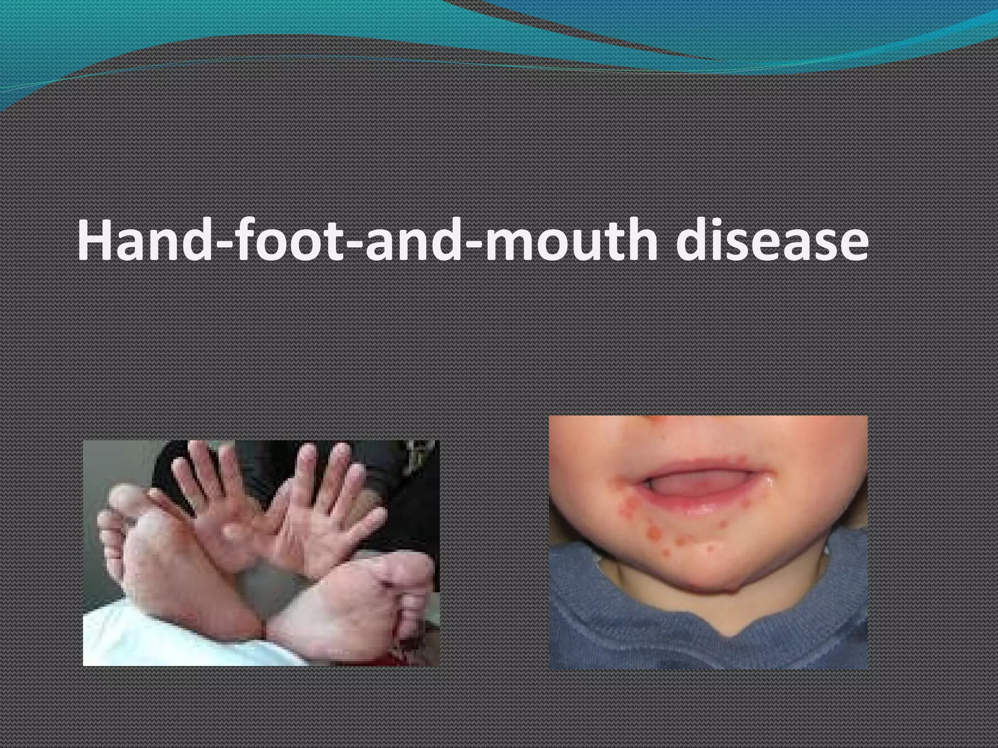 Hand Foot and Mouth Disease (HFMD) - RIS Clinic | PPT