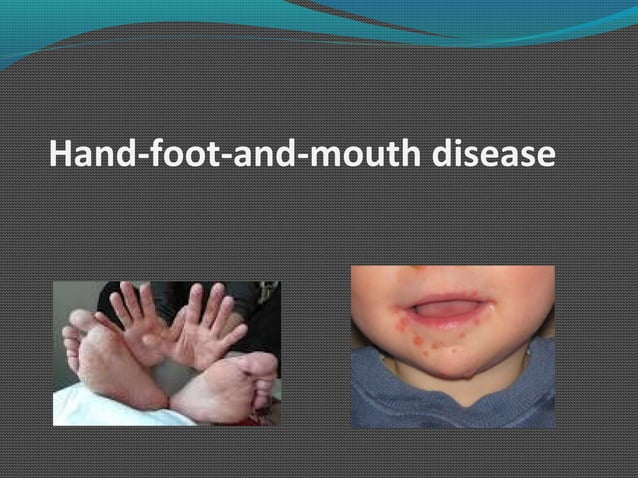 Hand Foot and Mouth Disease (HFMD) - RIS Clinic | PPT