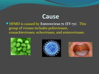 Hand Foot and Mouth Disease (HFMD) - RIS Clinic | PPT